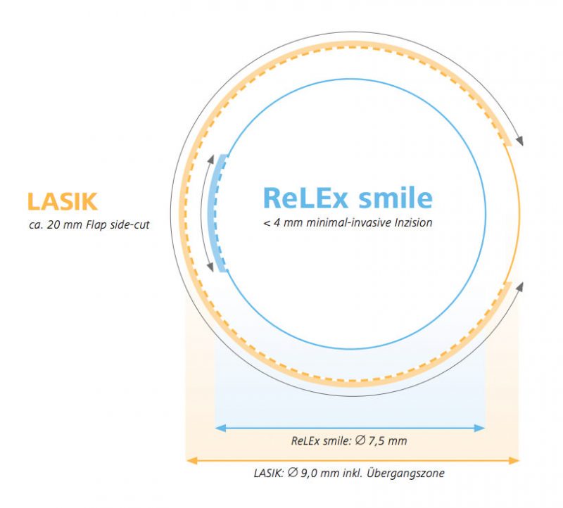 ReLEx SMILE - Vista Oftalmólogos - Safe & Visible