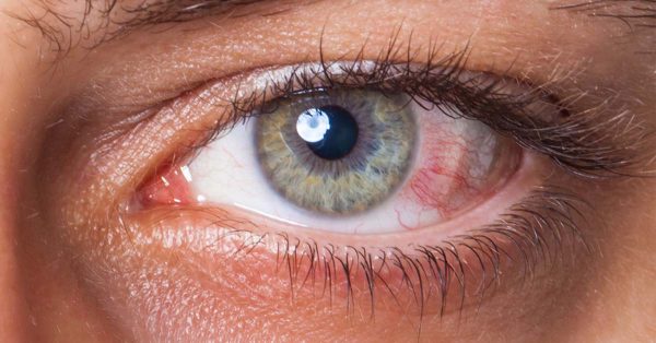 Escleritis: causas y síntomas – Vista Oftalmólogos – Safe & Visible