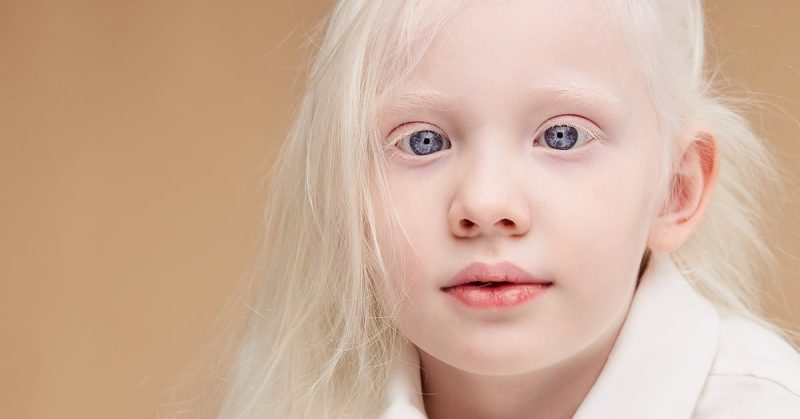 Cómo afecta el albinismo a la visión - Vista Oftalmólogos - Safe & Visible